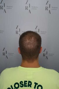 Dutasteride para la alopecia - Doctora Belén Tejedo